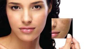 Melasma - The Medical Group of NJ - Navesink Dermatology